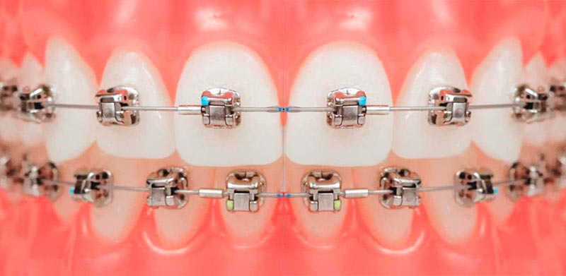 Ortodoncia Adultos - Ortodoncia Cali